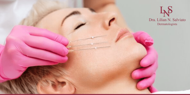 Fios de PDO Lisos: Saiba Tudo Sobre o Procedimento