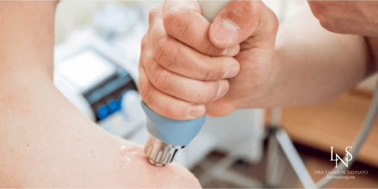 Criocirurgia: Como Funciona a Técnica?